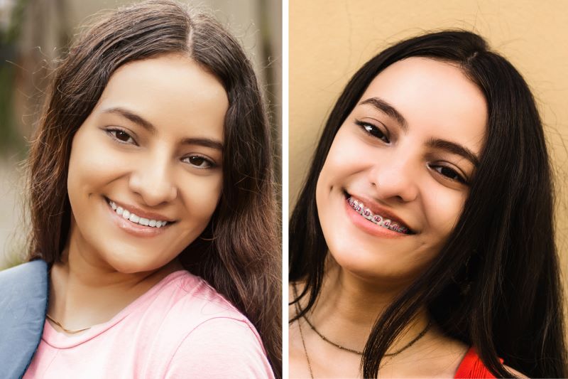 Crossing the Finish Line: What to Expect with Braces Removal